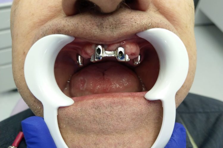 Caz protezare mobila cu proteze totale armate | PlazaDent.ro