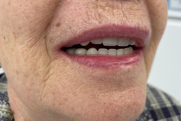 Caz protezare mobila cu proteze mobilizabile cu structura fixa (bara ...