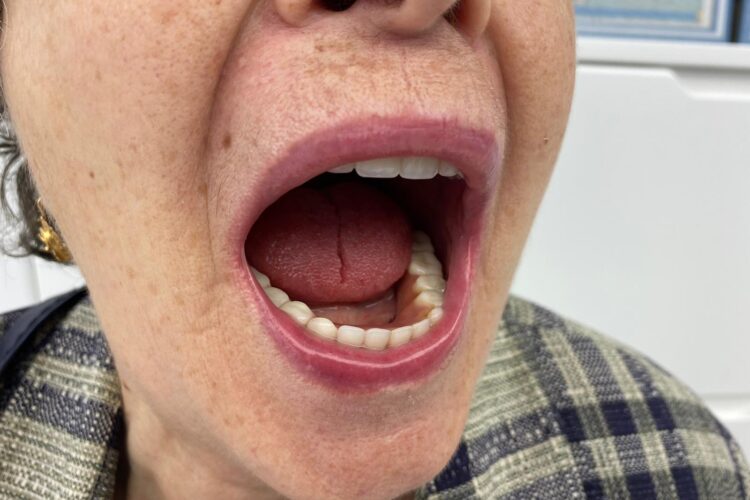 Caz protezare mobila cu proteze mobilizabile cu structura fixa (bara ...