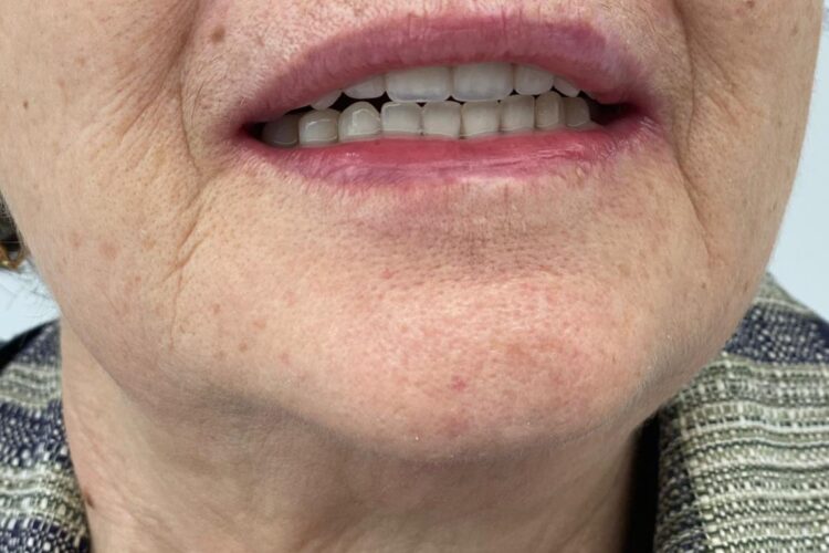 Caz protezare mobila cu proteze mobilizabile cu structura fixa (bara ...